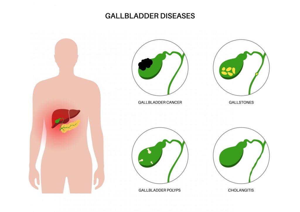 Gallbladder Disorders: Recognizing Symptoms, Understanding Causes, and ...